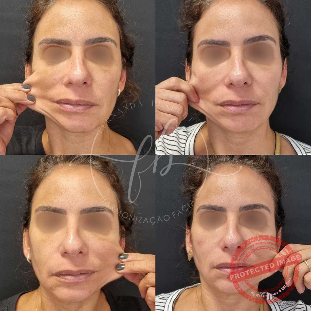 Fios de PDO - Dra. Fernanda Benedette